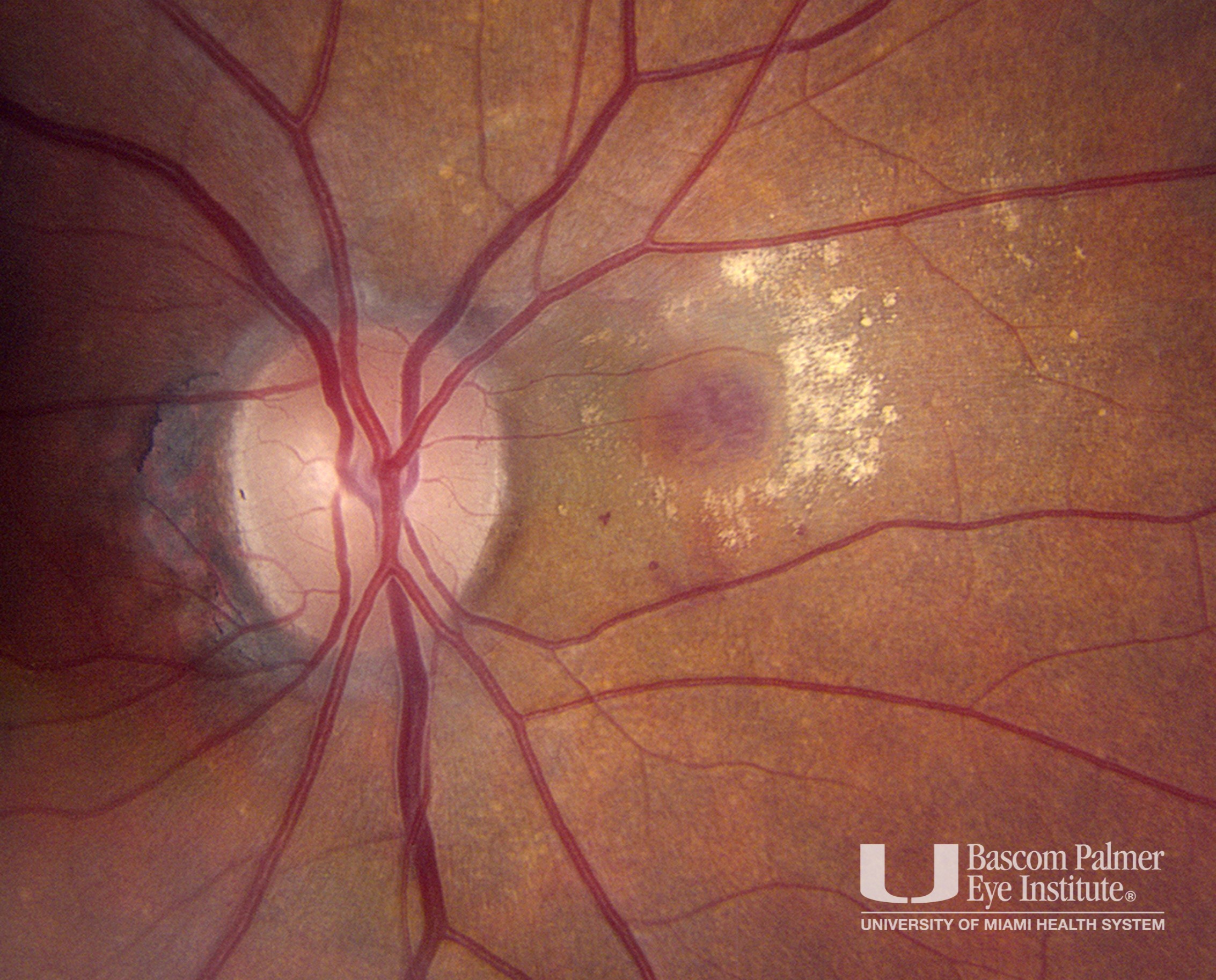 Course: Polypoidal Choroidal Vasculopathy